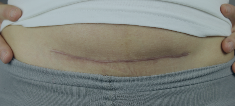 Uterine Rupture Lawsuit | Birth Injury Attorneys in Covington & Cincinnati