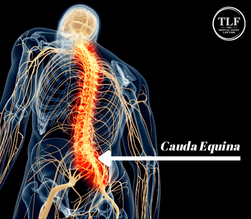 Conus Medullaris and Cauda Equina Syndrome Malpractice Lawyers