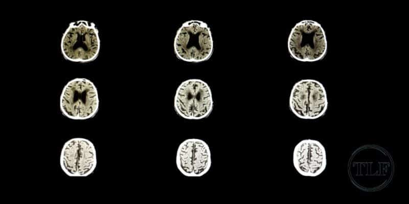 Failure to Treat a Stroke With tPA | TLF: The Medical Injury Law Firm