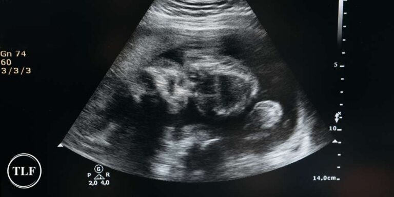 Marginal Cord Insertion - Causes, Risks, and Related Birth Injuries