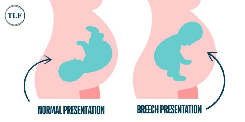Kentucky and Ohio Attorneys for Breech Presentation Birth Injuries